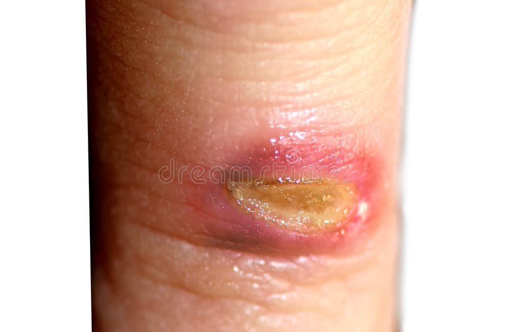 Skin Wound. Burn on the Skin of the Finger. Stock Image - Image of ...