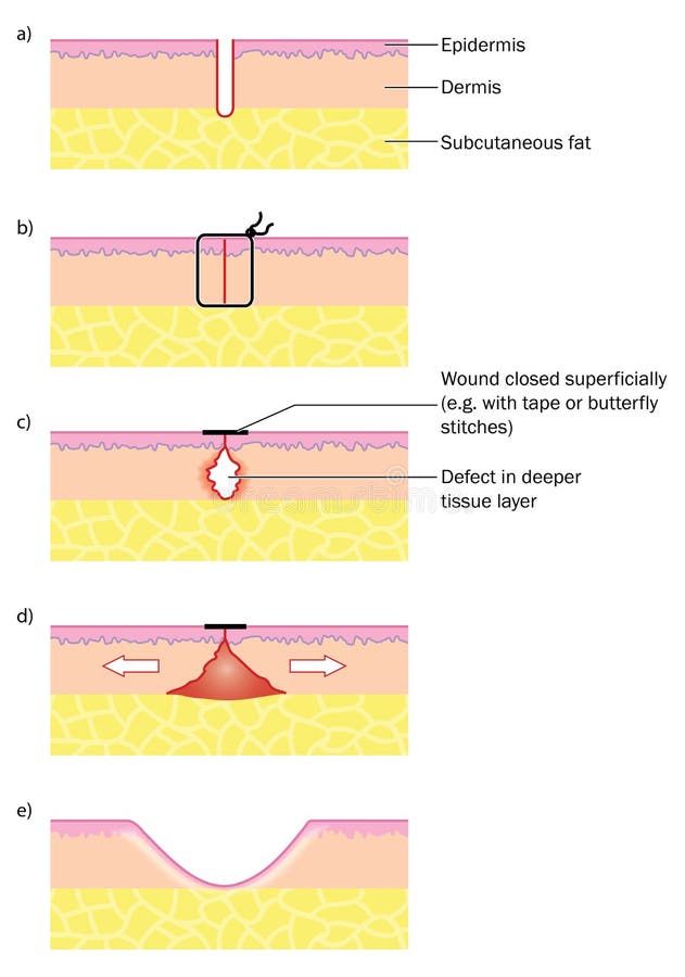 Skin wound closure stock vector. Illustration of medicine - 92479590