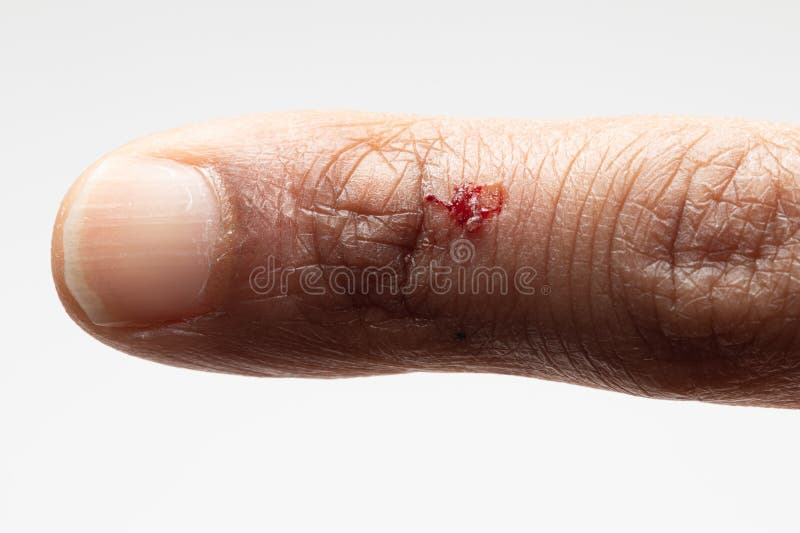 Skin Wounds and Healing Problems Stock Image - Image of abrasion, hand ...