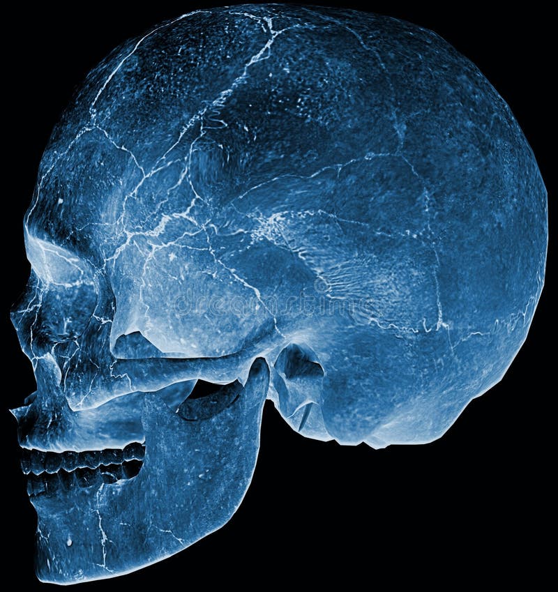 Skull head side x ray stock illustration. Illustration of arthritis ...