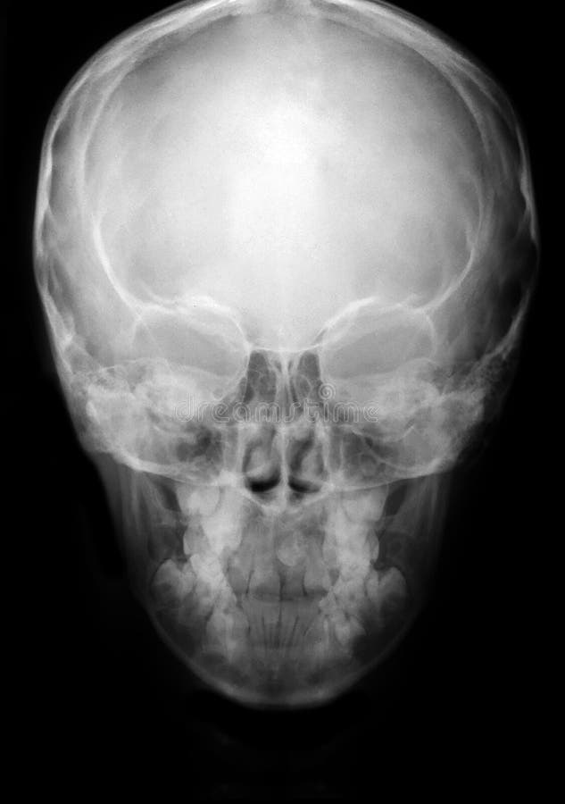 Radiography of skull stock image. Image of picture, radiography - 6900505