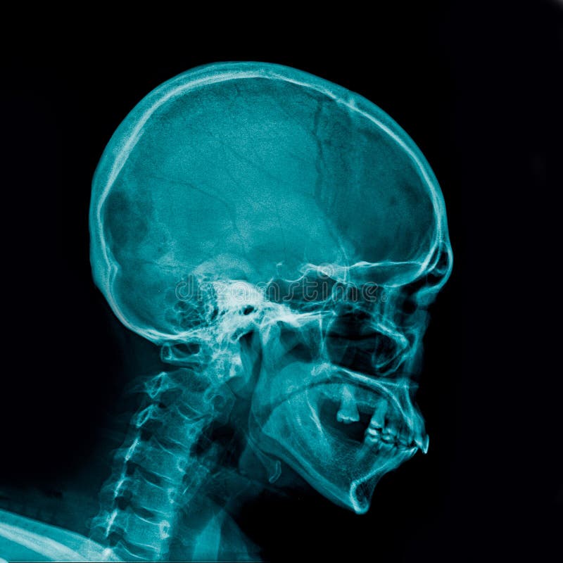 Skull X-ray AP and Lateral View Stock Illustration - Illustration of ...