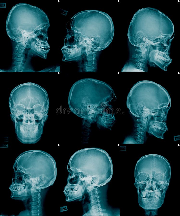 Collection of Skull X-ray Image of Human Skull AP , Lateral and Water ...