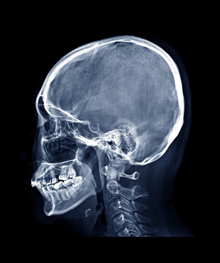 Skull X-ray Image of Human Skull Lateral View. Stock Image - Image of ...