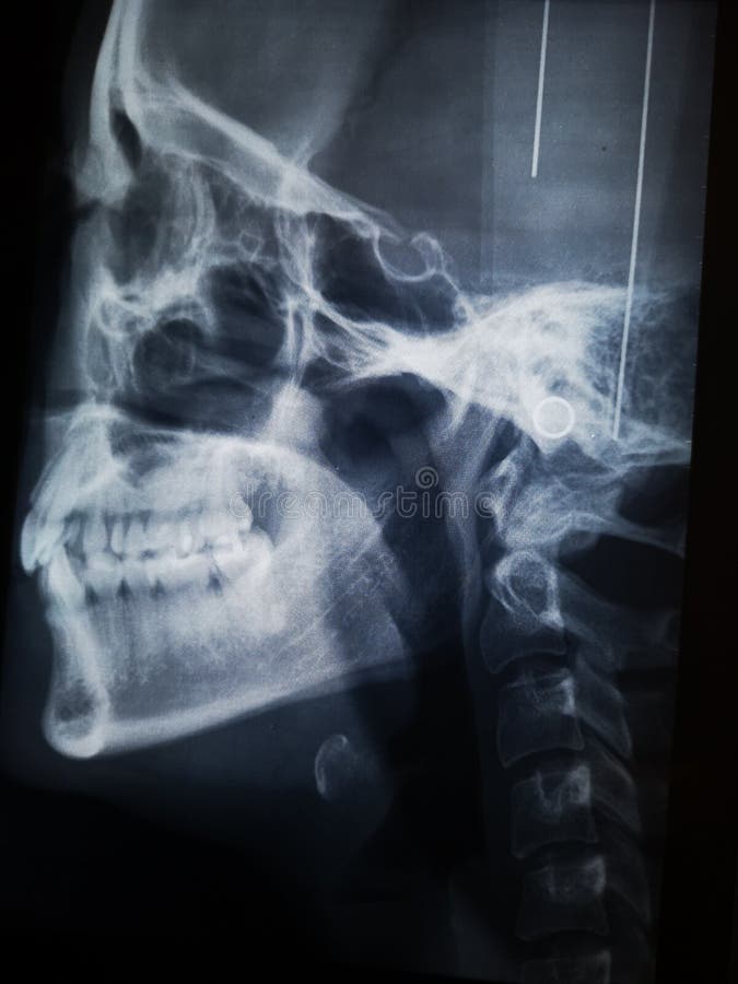 Medical x-ray of teeth stock image. Image of science - 223645409