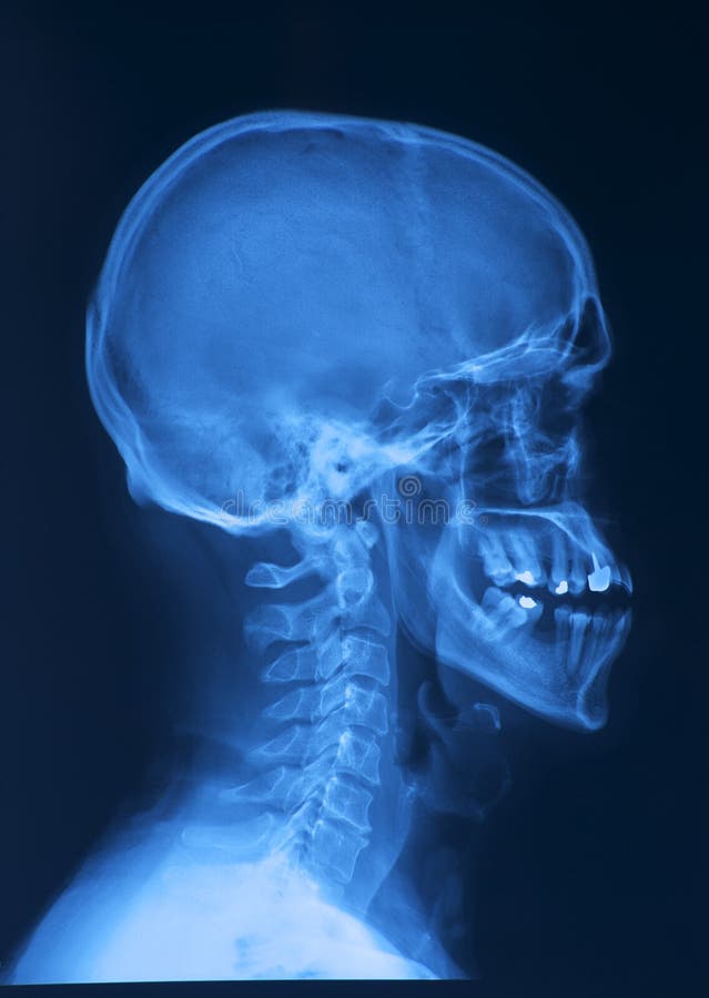 Skull X-ray Image Stock Photography - Image: 12941892