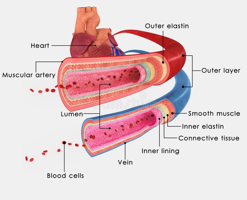 Atherosclerose & Arteriosclerose Vector Illustratie - Illustration of ...