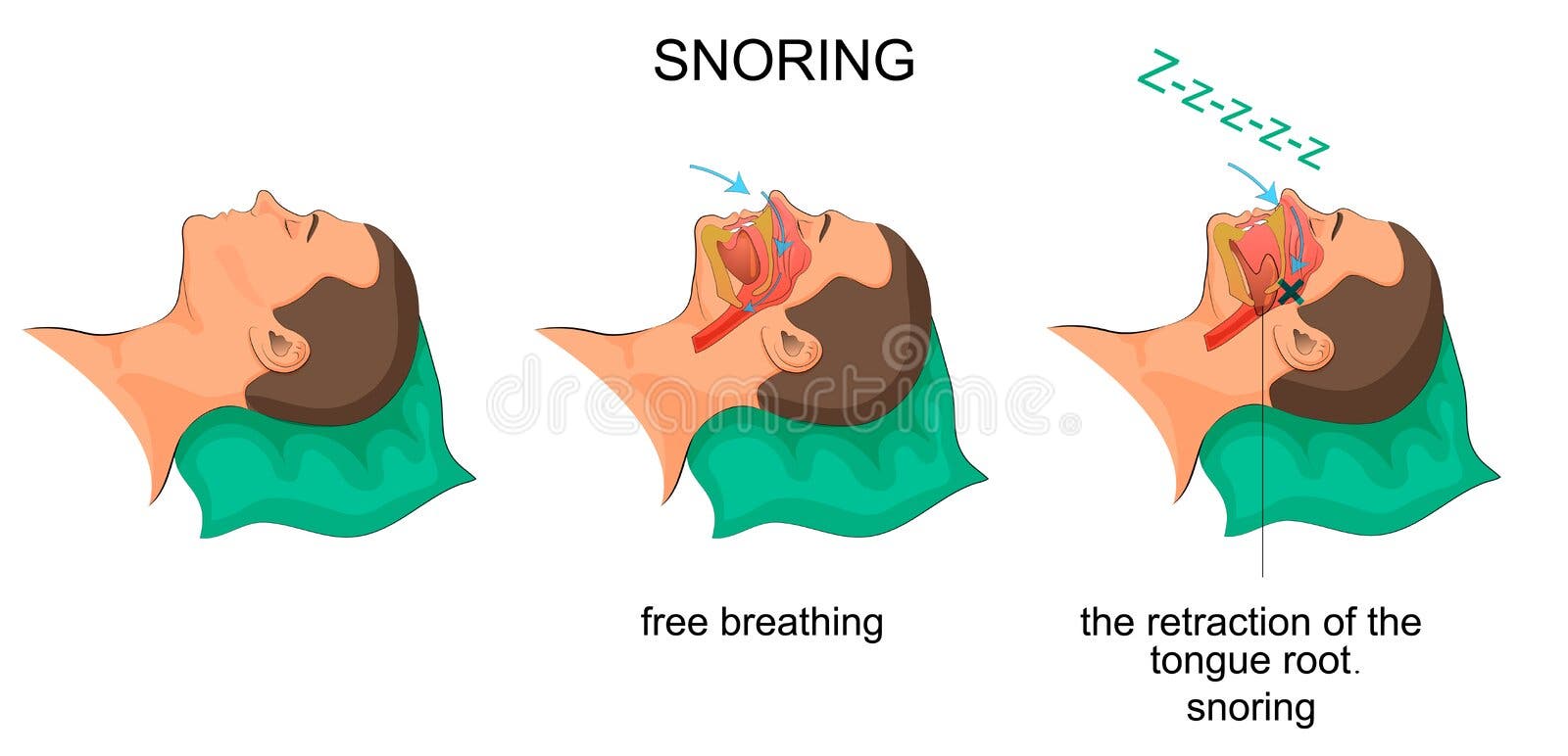 Snoring sleep. stock illustration. Illustration of syndrome - 83394327