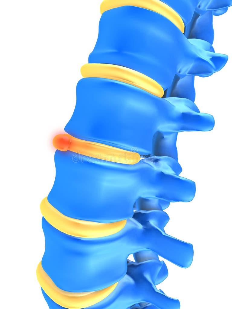 Vertebral Disc Stock Illustrations – 933 Vertebral Disc Stock ...