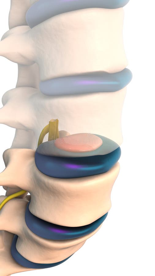 Slipped Disk or a Ruptured Disk Stock Illustration - Illustration of ...