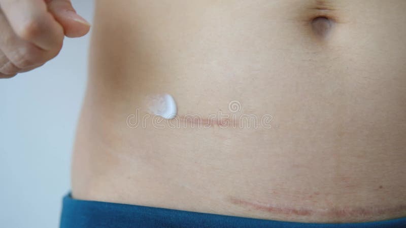 Slow Motion Using Cream To Care for Scars after Appendix Surgery. Stock ...