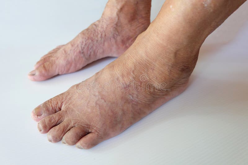 Spataders in De Voeten En De Benen Stock Afbeelding - Image of collage ...