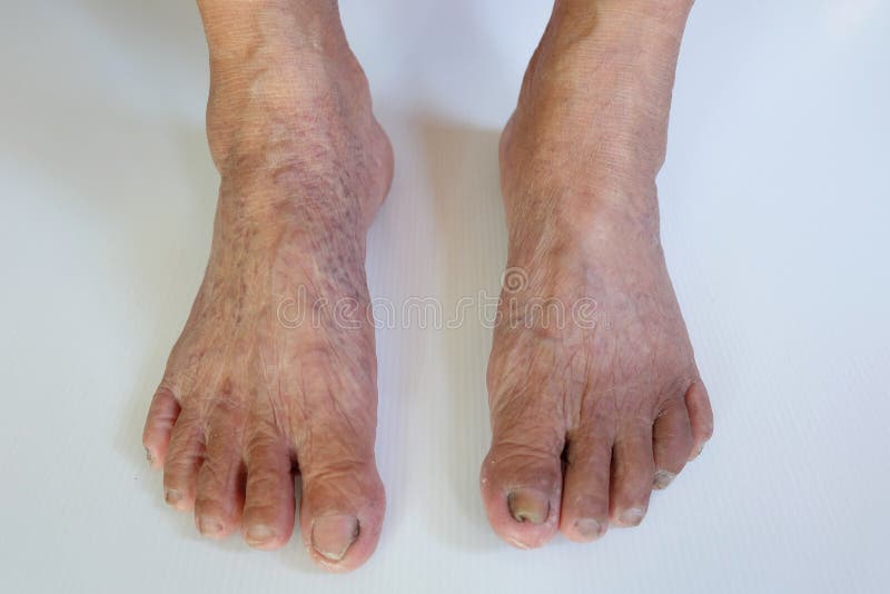 Spataders In De Voeten En De Benen Stock Foto - Afbeelding bestaande ...