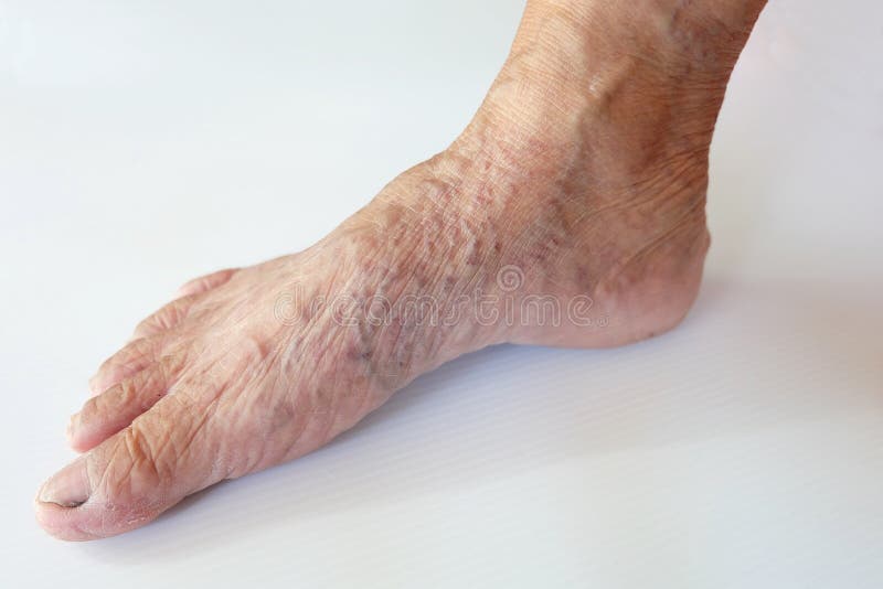 Spataders in De Voeten En De Benen Stock Foto - Image of voeten, vorm ...