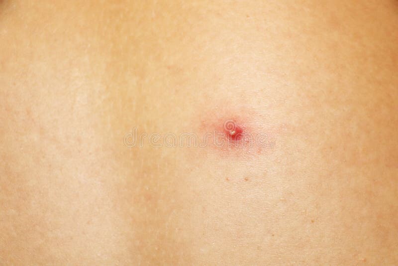 Sluit Omhoog Van Een Pukkel Op De Rug Stock Foto - Image of kaak ...