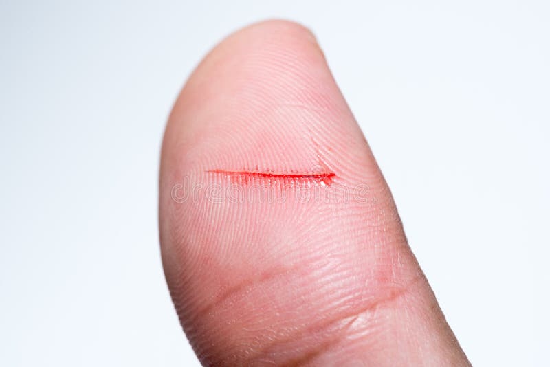 De Mens Behandelt Letsel of Wond Op Zijn Wapen Met Rode Geneeskunde ...