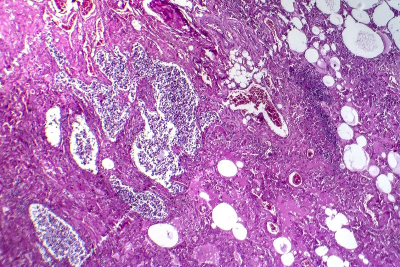 Small cell lung cancer stock photo. Image of microscope - 130899624