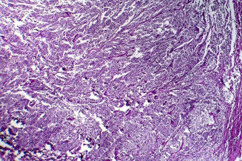 Small cell lung cancer stock photo. Image of photomicrograph - 130899920