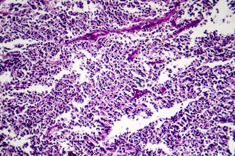 Small Cell Lung Cancer Histology