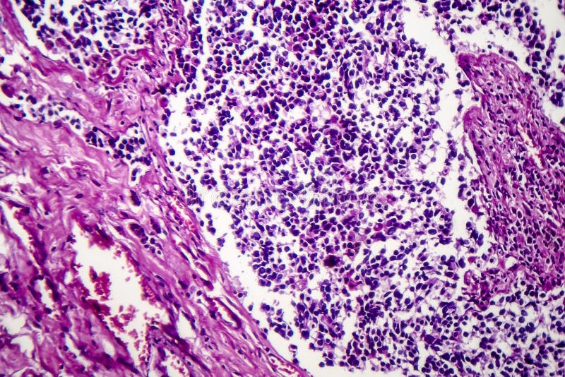 Small cell lung cancer stock image. Image of neoplasm - 130900039