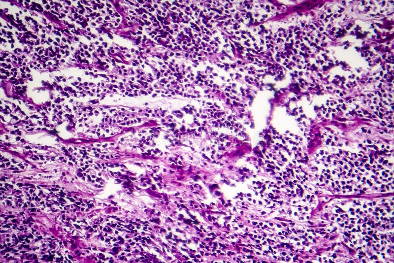 Small cell lung cancer stock photo. Image of lung, photomicrograph ...