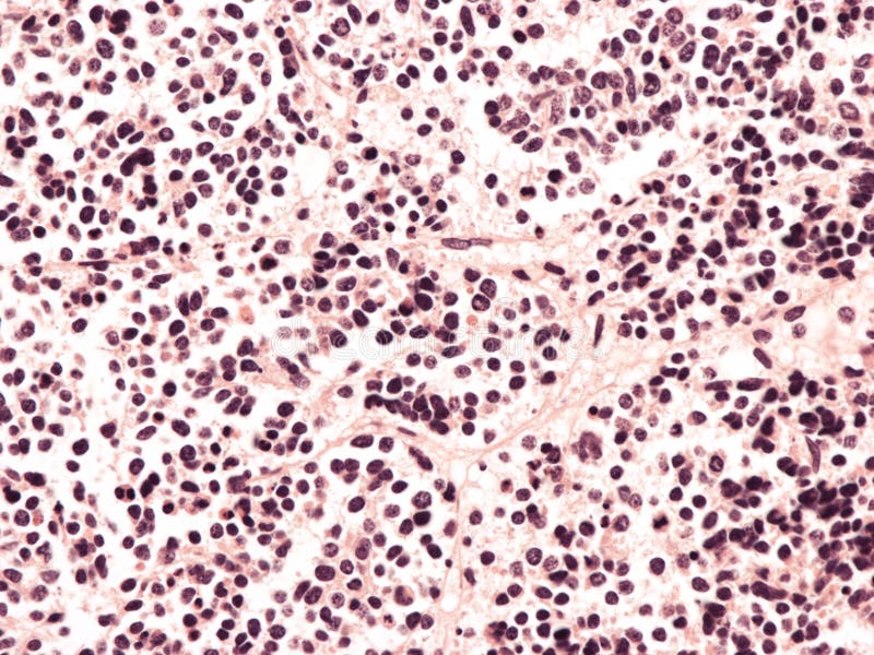 Small-cell Lung Carcinoma in Bone Marrow. Stock Photo - Image of ...