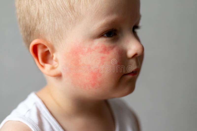 Small Child with Red Rash on Cheek Stock Image - Image of outbreak ...