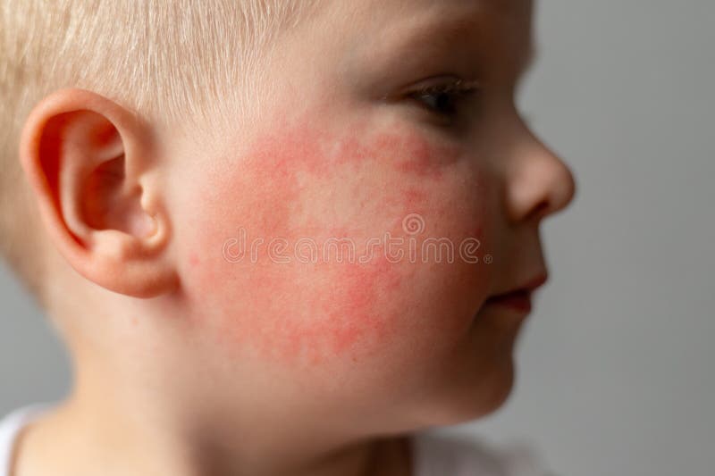 Small Child with Red Rash on Cheek Stock Photo - Image of baby ...