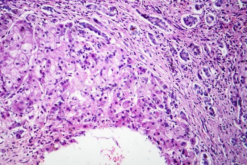 Small Nodular Cirrhosis, Light Micrograph Stock Image - Image of ...