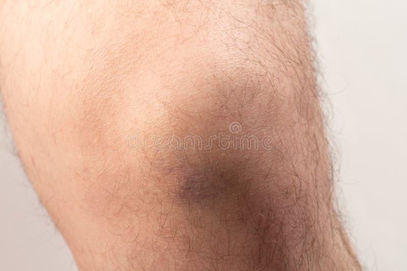 Small wound on human knee stock image. Image of bruise - 253988573