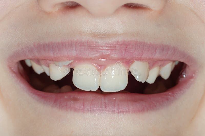 Smile of a Boy with Teeth Growth Defects Stock Photo - Image of ...