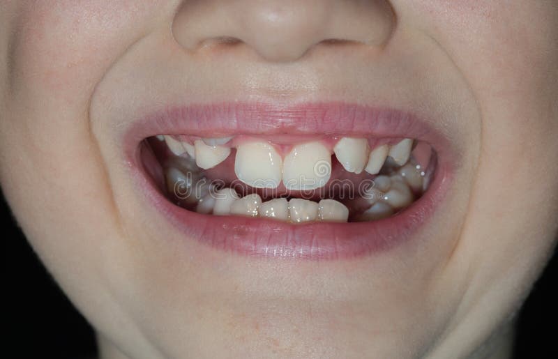 Smile of a Boy with Teeth Growth Defects Stock Image - Image of child ...