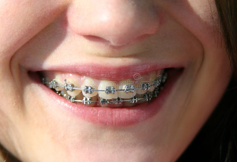 Smile with Brackets on Teeth Stock Photo - Image of lips, health: 527956