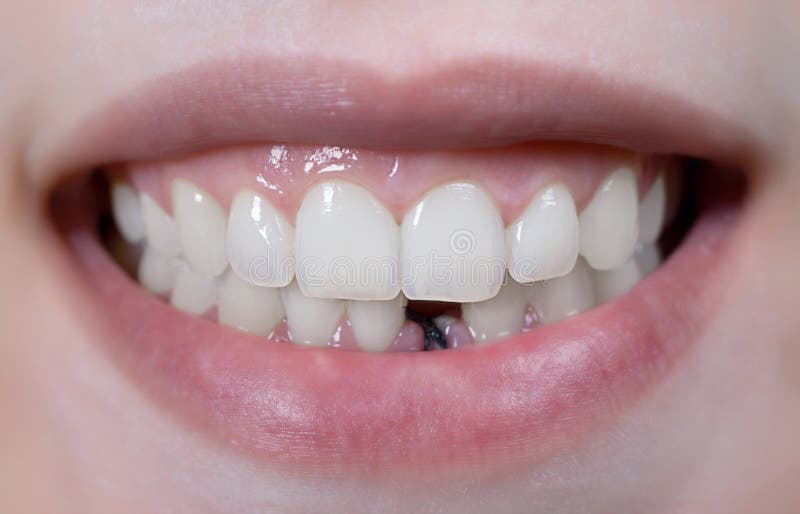 Smile without front tooth stock photo. Image of concept - 47675902