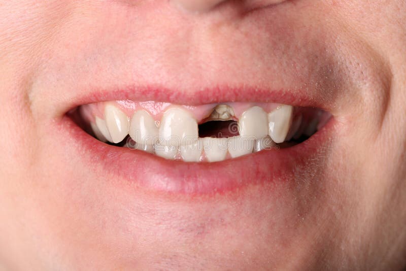 Smile without front tooth stock image. Image of mouth - 48844989