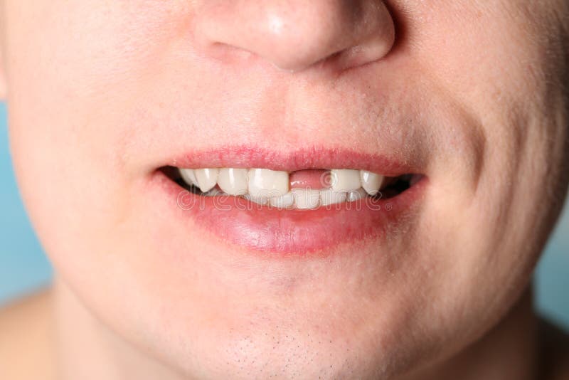 Smile without front tooth stock image. Image of cheerful - 49287367
