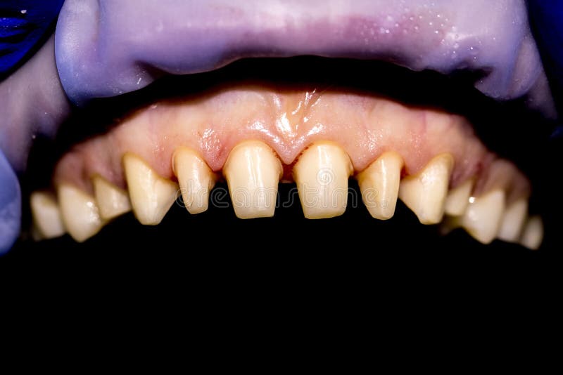 Hollywood Smile with Porcelain Crowns and Veneers Stock Photo - Image ...