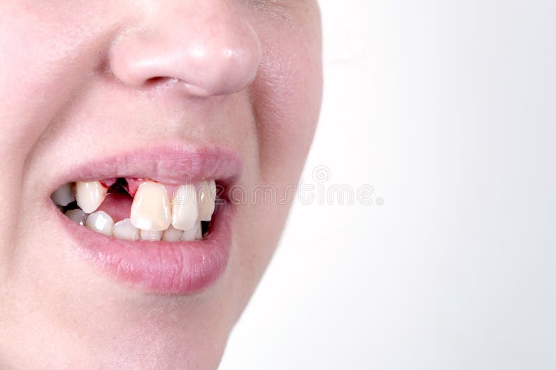 Smile of Woman without Front Teeth Stock Photo - Image of close, beauty ...