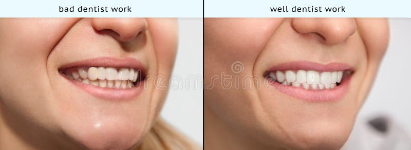 Young Woman with Bad Dentist Work and Well Dentist Work Stock Photo ...