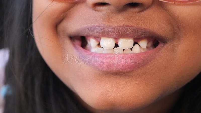 Smiling Child Showcases Missing Front Teeth during Summer Fun Stock ...