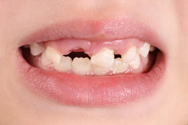 Smiling Child without Teeth Close-up Stock Photo - Image of person ...