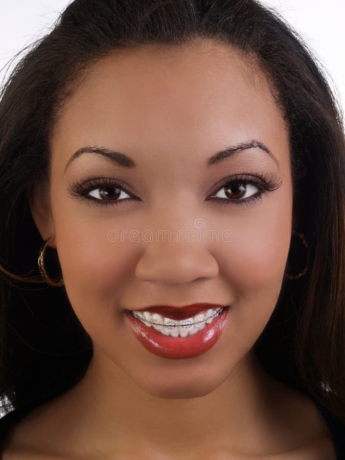 Smiling Young Black Woman with Braces Upper Teeth Stock Photo - Image ...