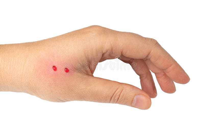 Snake Bite on Skin, Snakebite or Cat Bite Marks Close Up. Two Small ...