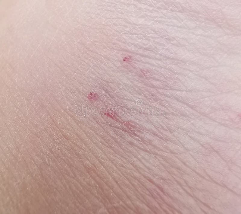 Snake bite stock photo. Image of life, path, medicine - 337614682