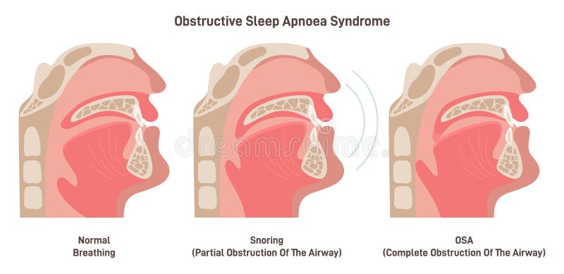 Snoring And Osa Sleep Apnea Snoring Syndrome Anatony Stock Vector