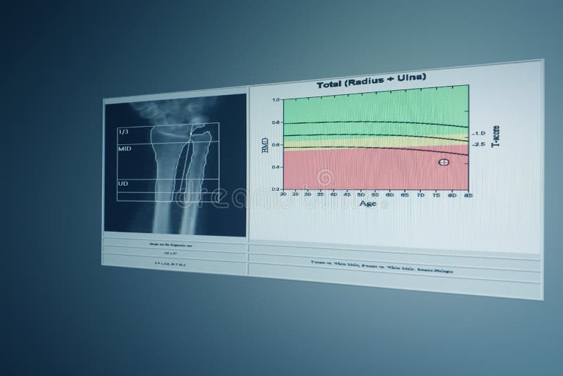 Normal Bone Mineral Density Age Stock Photos - Free & Royalty-Free ...