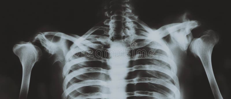 Intricate Details of Human Rib Cage Highlighted with Subtle Gradient in ...