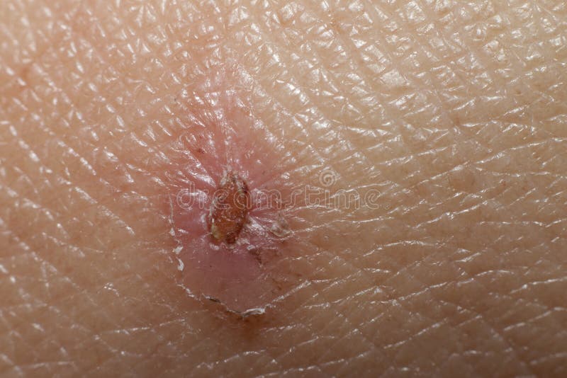 Soft Wounds on the skin stock image. Image of macro, injured - 86595973