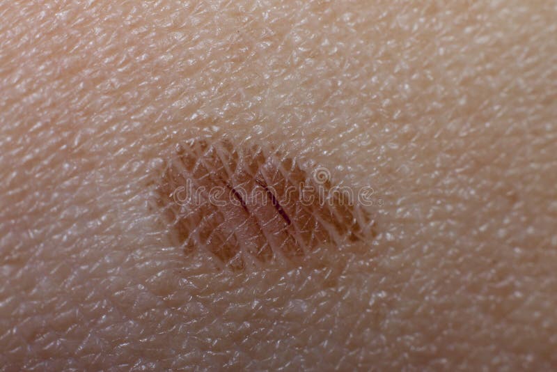 Soft Wounds on the skin stock photo. Image of abstract - 86596214