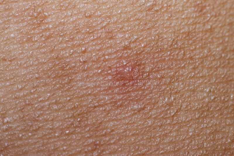 Soft Wounds on the skin stock image. Image of harm, injured - 86596743